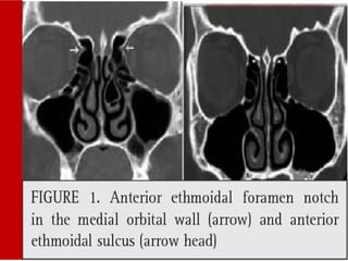 ANTERIOR AND POSTERIOR ETHMOID ARTERIES.pptx