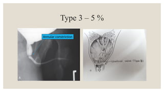 Anterior and Posterior Urethral Valves.pptx