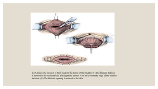 Anterior and Posterior Urethral Valves.pptx