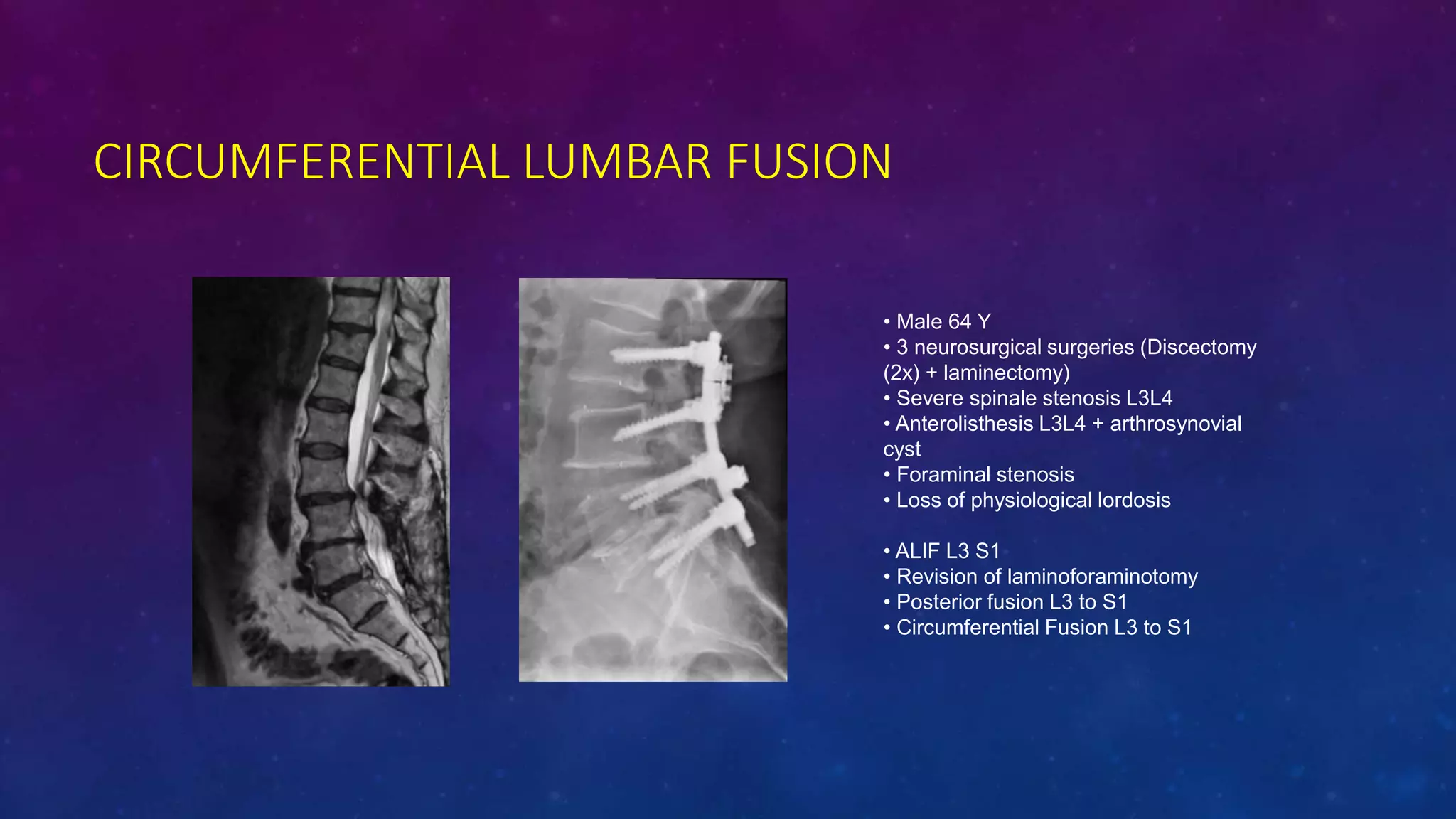 Anterior Approach & Lumbar Disc Prosthesis | PPT
