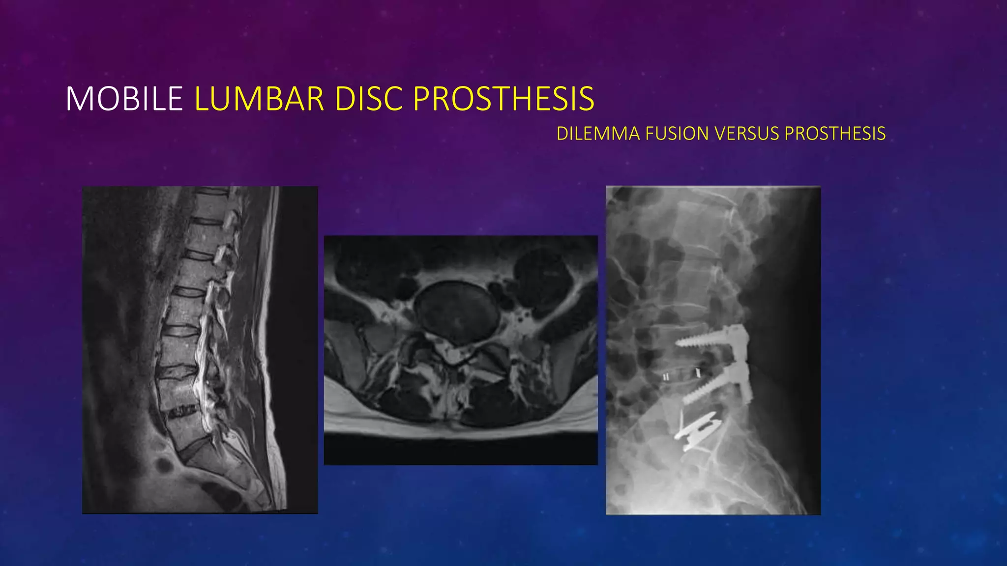 Anterior Approach & Lumbar Disc Prosthesis | PPT