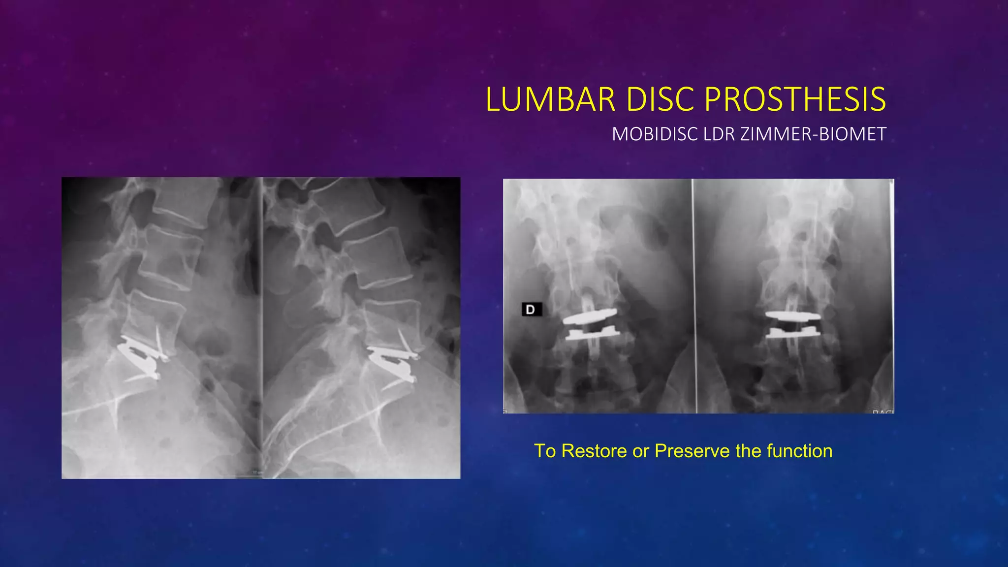 Anterior Approach & Lumbar Disc Prosthesis | PPT