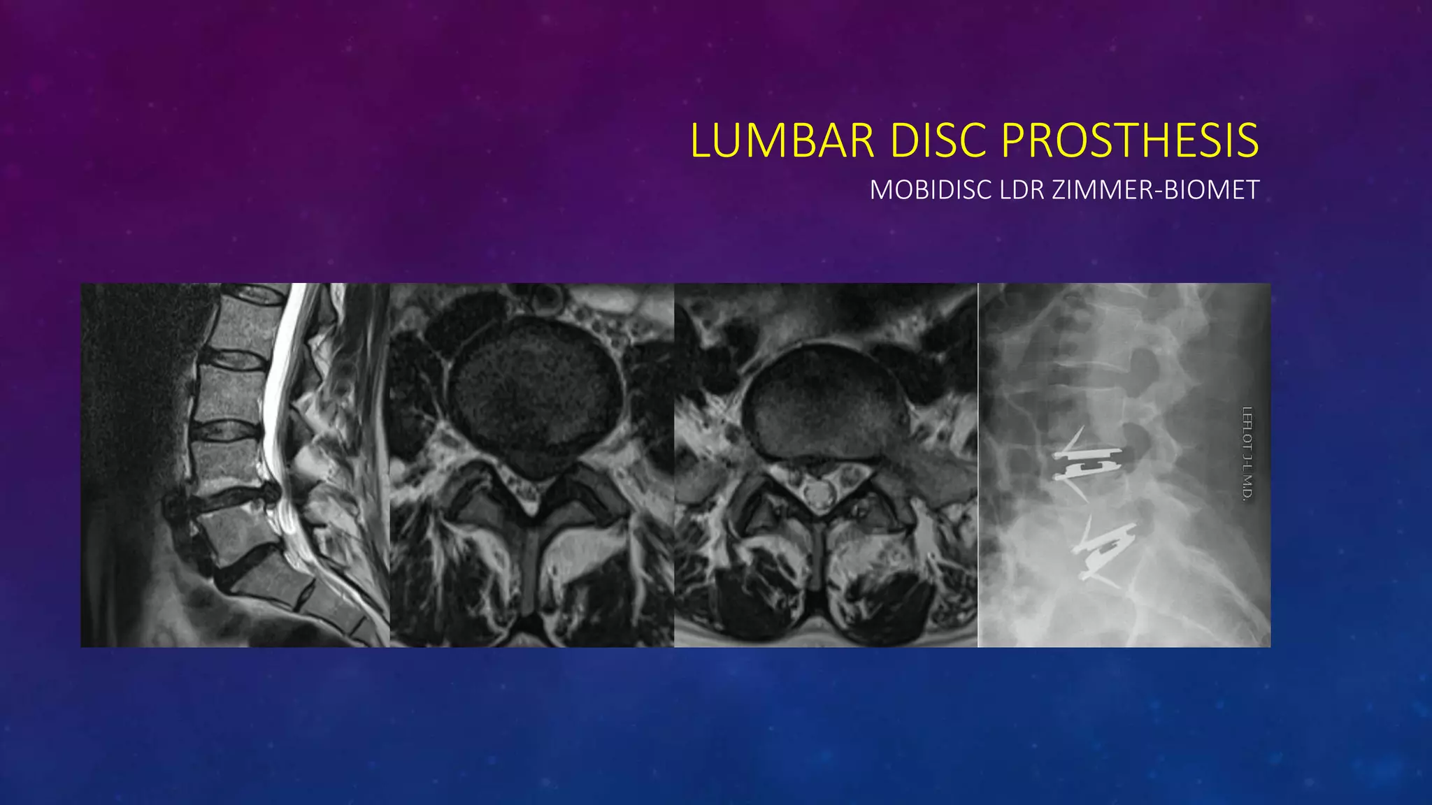 Anterior Approach & Lumbar Disc Prosthesis | PPT