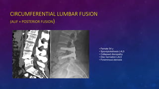 Anterior Approach & Lumbar Disc Prosthesis | PPT