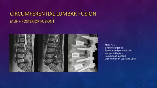 Anterior Approach & Lumbar Disc Prosthesis | PPT