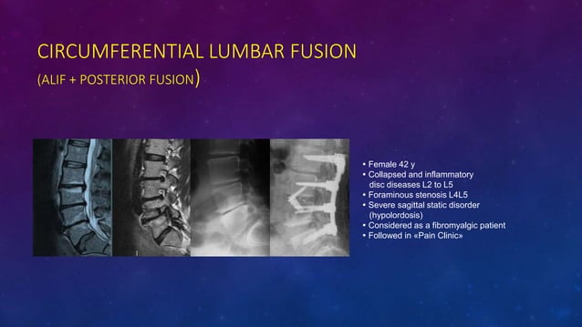 Anterior Approach & Lumbar Disc Prosthesis | PPT