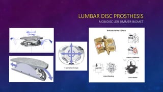 Anterior Approach & Lumbar Disc Prosthesis | PPT