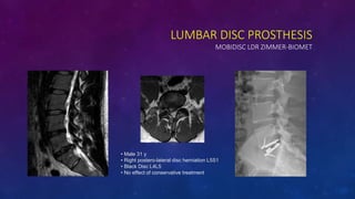 Anterior Approach & Lumbar Disc Prosthesis | PPT