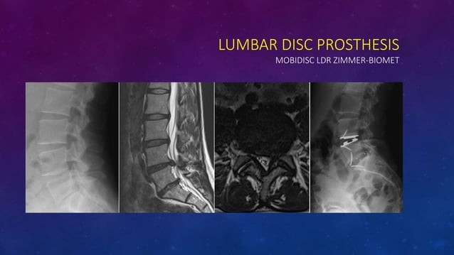 Anterior Approach & Lumbar Disc Prosthesis | PPT