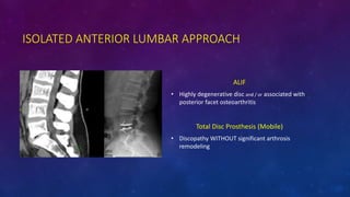 Anterior Approach & Lumbar Disc Prosthesis | PPT
