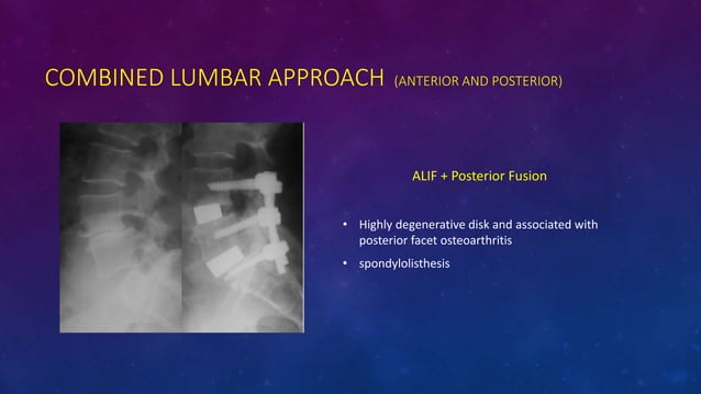 Anterior Approach & Lumbar Disc Prosthesis | PPT