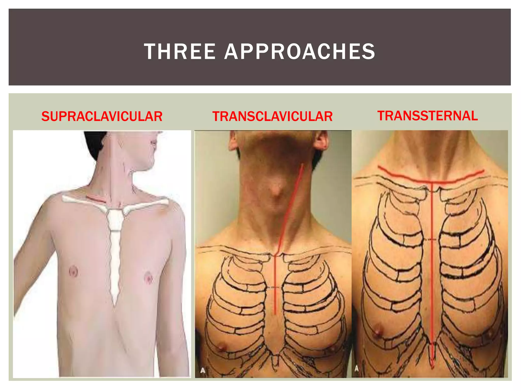 Anterior Approaches To The Thoracic Spine | PPTX