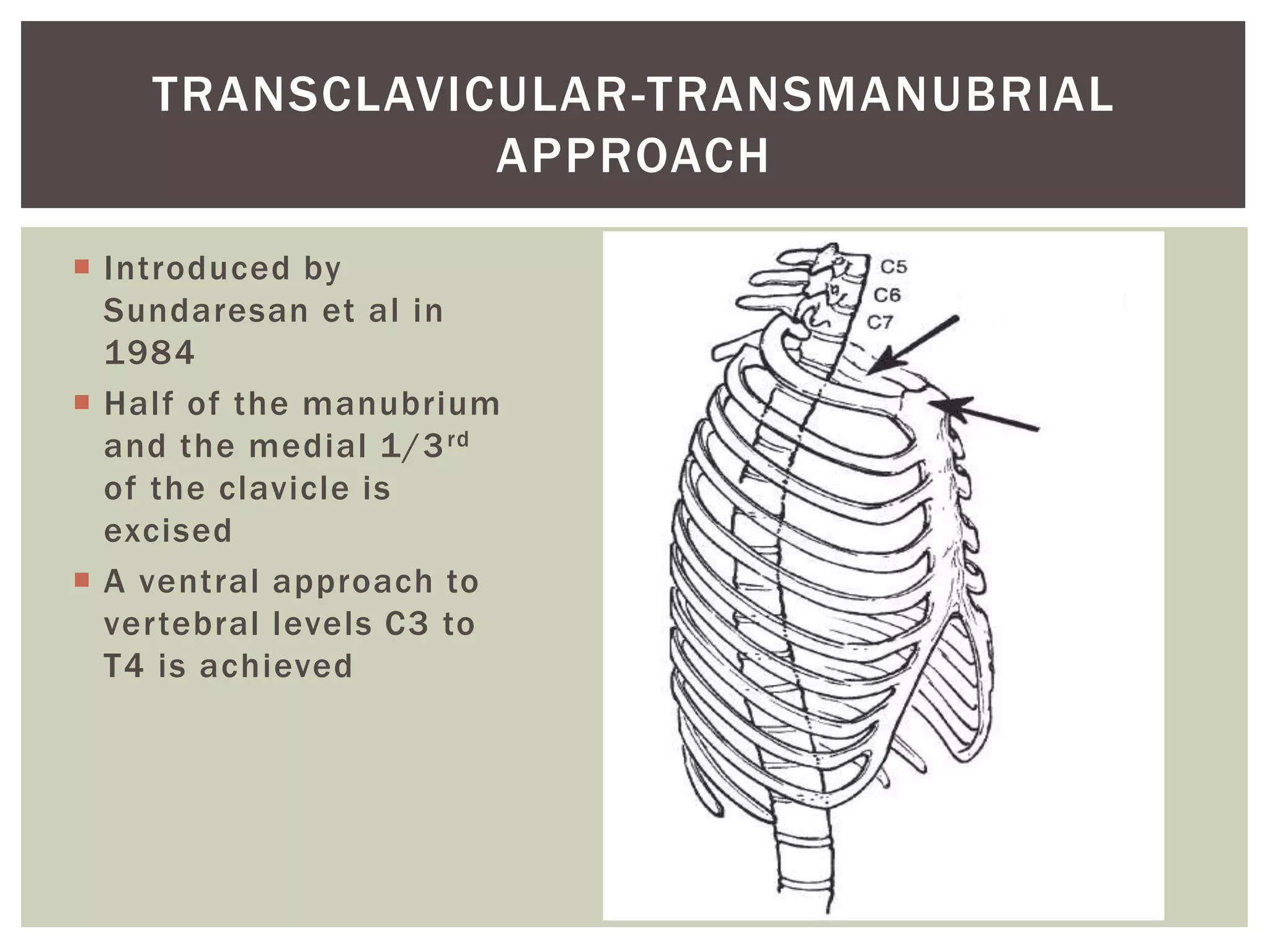 Anterior Approaches To The Thoracic Spine | PPTX