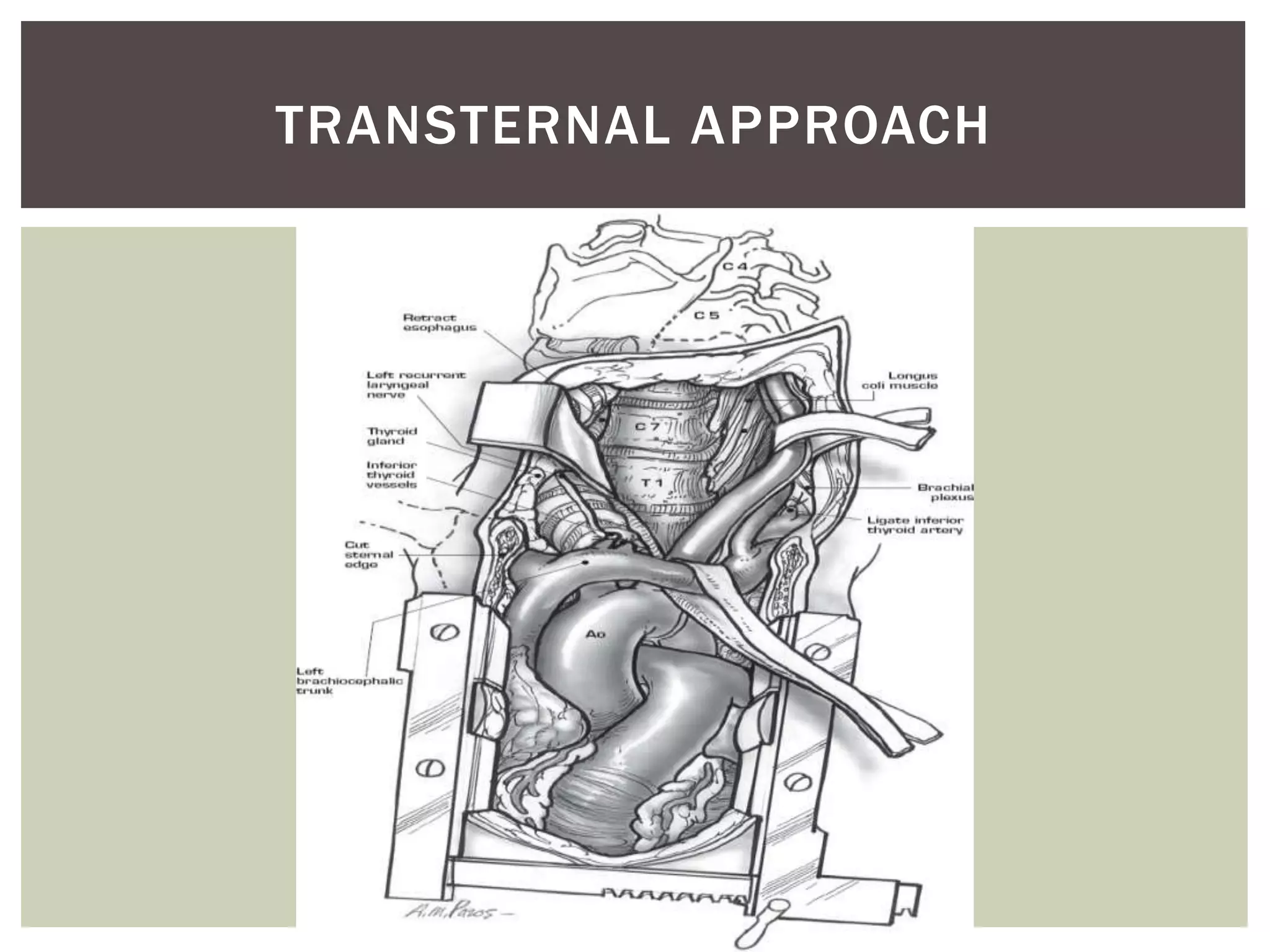 Anterior Approaches To The Thoracic Spine | PPTX