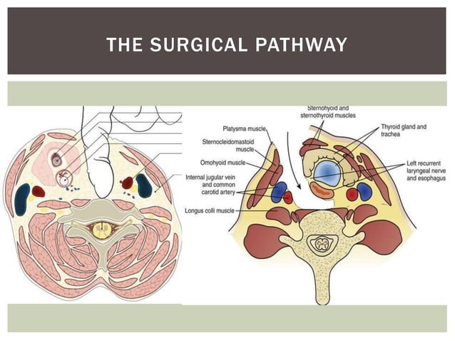 Anterior Approaches To The Thoracic Spine | PPT