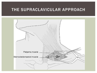 Anterior Approaches To The Thoracic Spine | PPTX