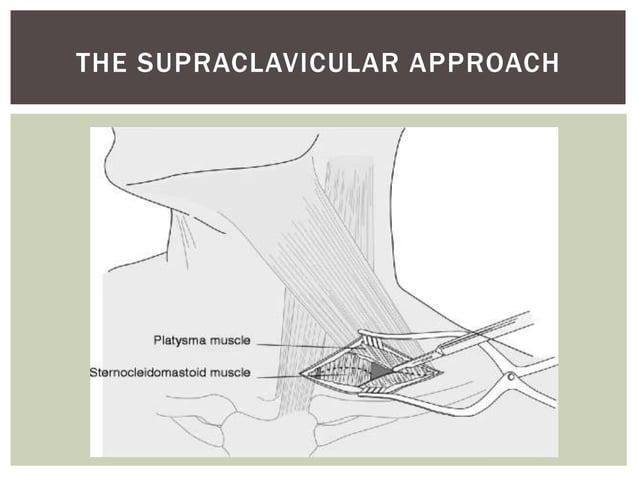 Anterior Approaches To The Thoracic Spine | PPT