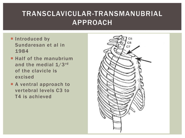 Anterior Approaches To The Thoracic Spine | PPT