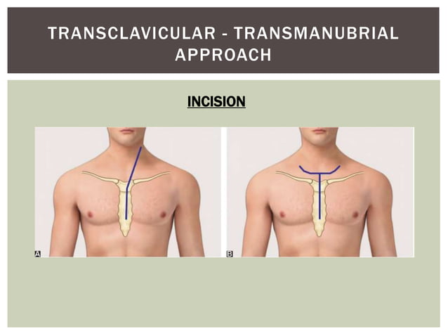 Anterior Approaches To The Thoracic Spine | PPT