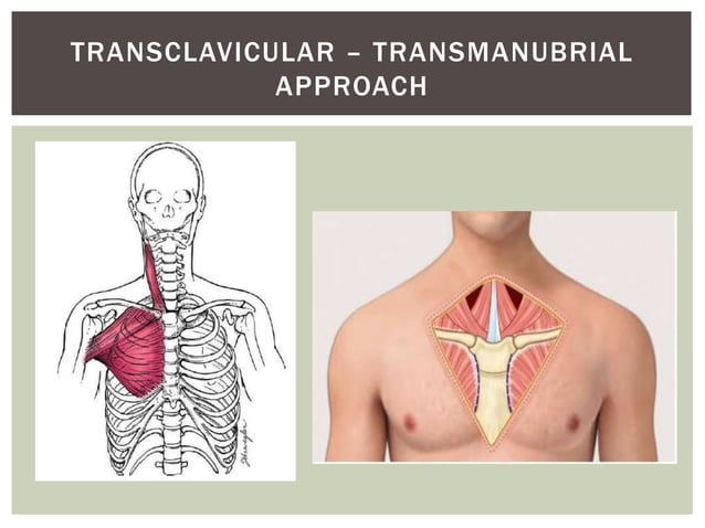 Anterior Approaches To The Thoracic Spine | PPT