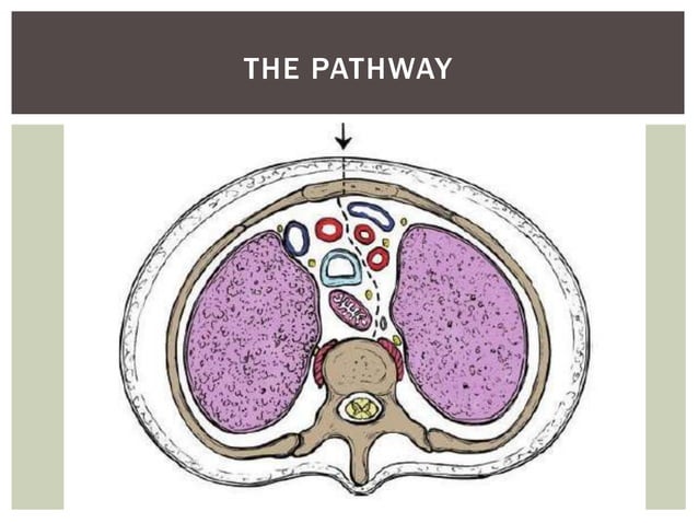 Anterior Approaches To The Thoracic Spine | PPT