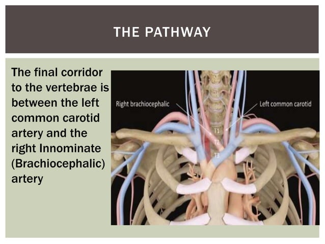 Anterior Approaches To The Thoracic Spine | PPT