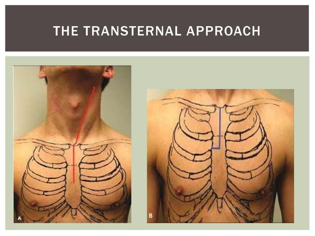 Anterior Approaches To The Thoracic Spine | PPT