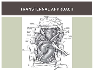 Anterior Approaches To The Thoracic Spine | PPTX