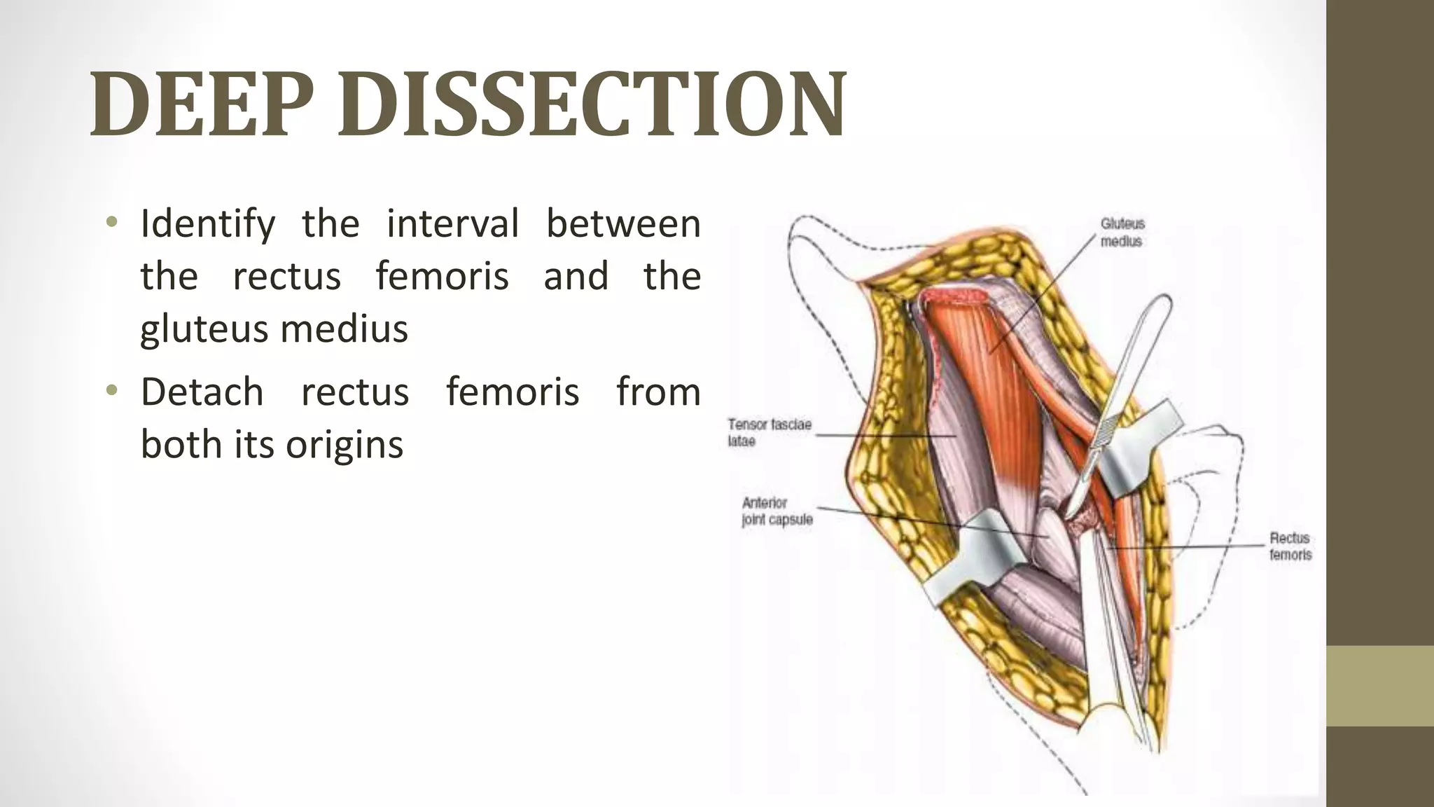 Anterior approach to the hip - Dr. Sachin M | PPTX