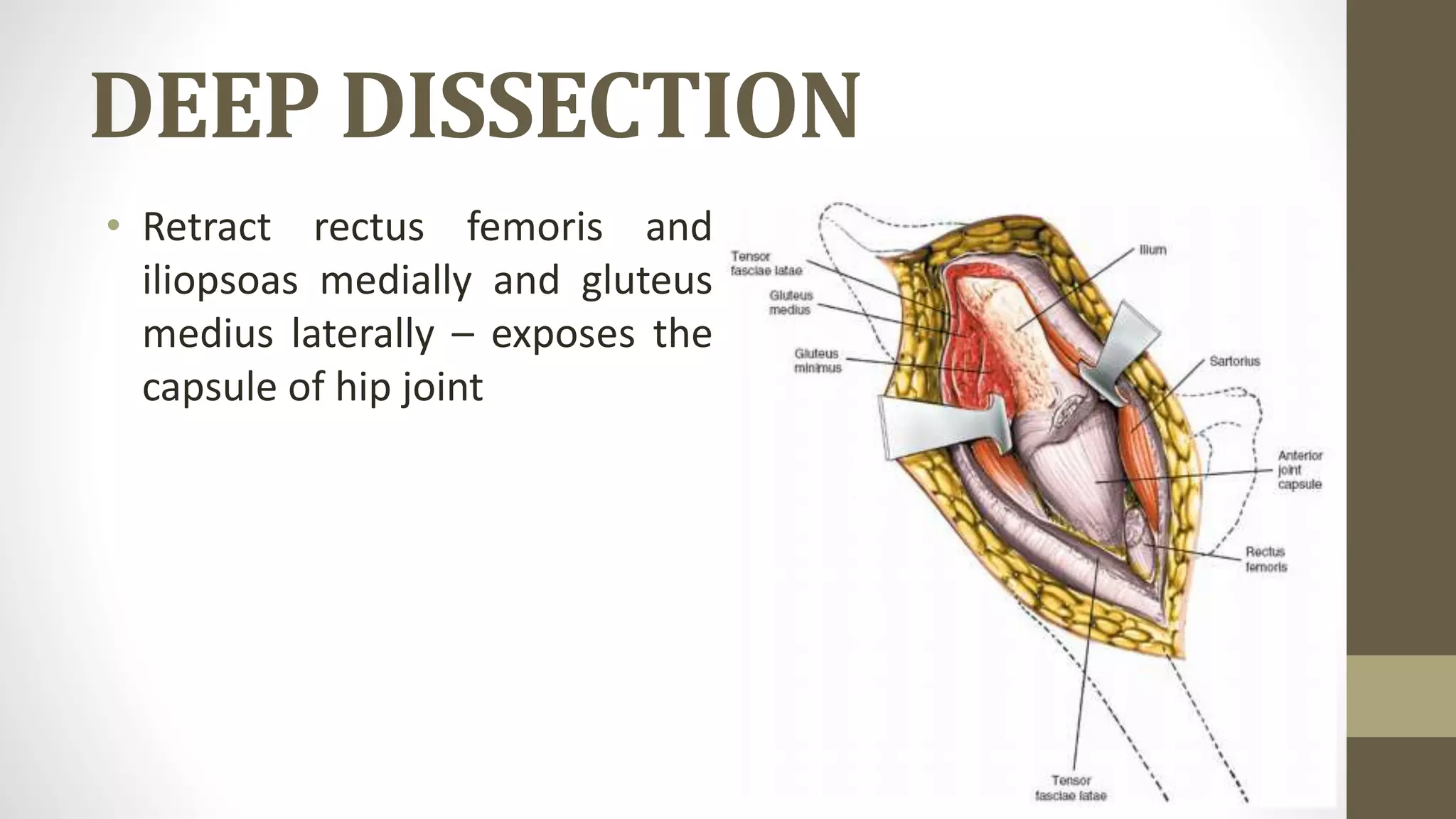 Anterior approach to the hip - Dr. Sachin M | PPTX