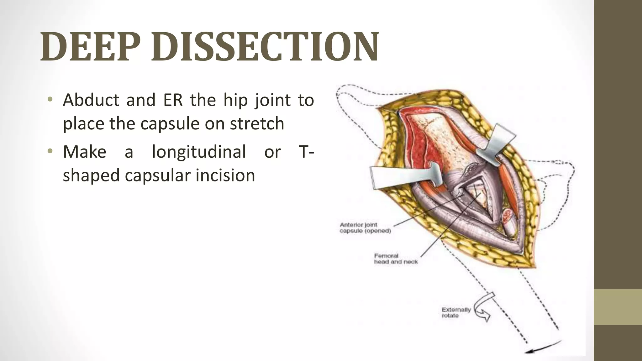 Anterior approach to the hip - Dr. Sachin M | PPTX