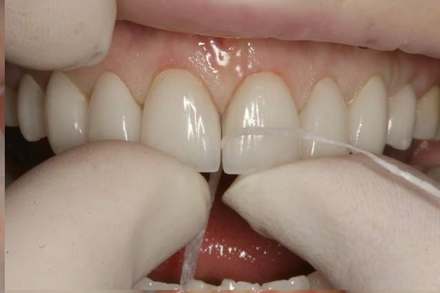 Anterior cementation technique guide | PPT