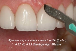 Anterior cementation technique guide | PPT