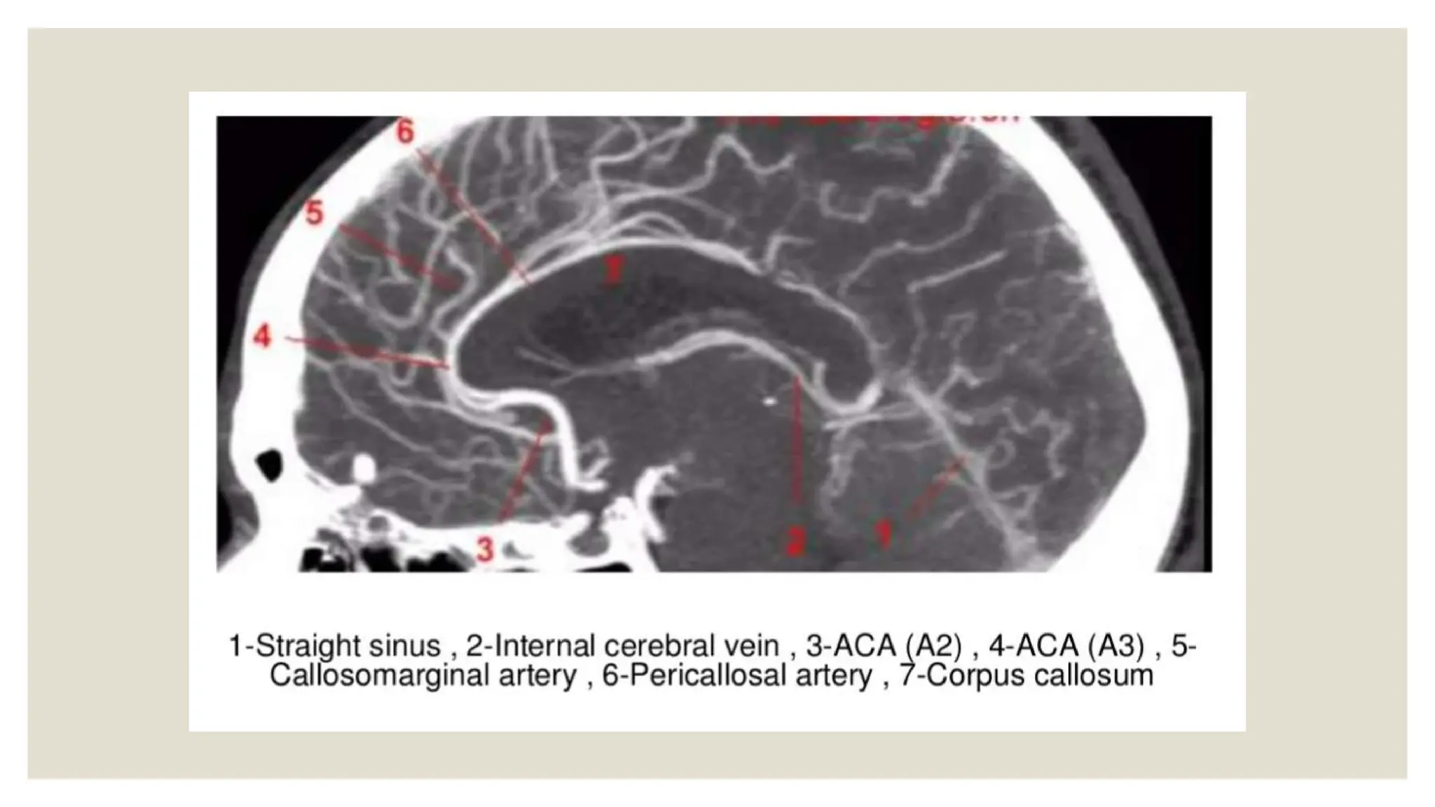 Anterior Cerebral Artery, anatomy, segments, pathologies, radiology | PPTX