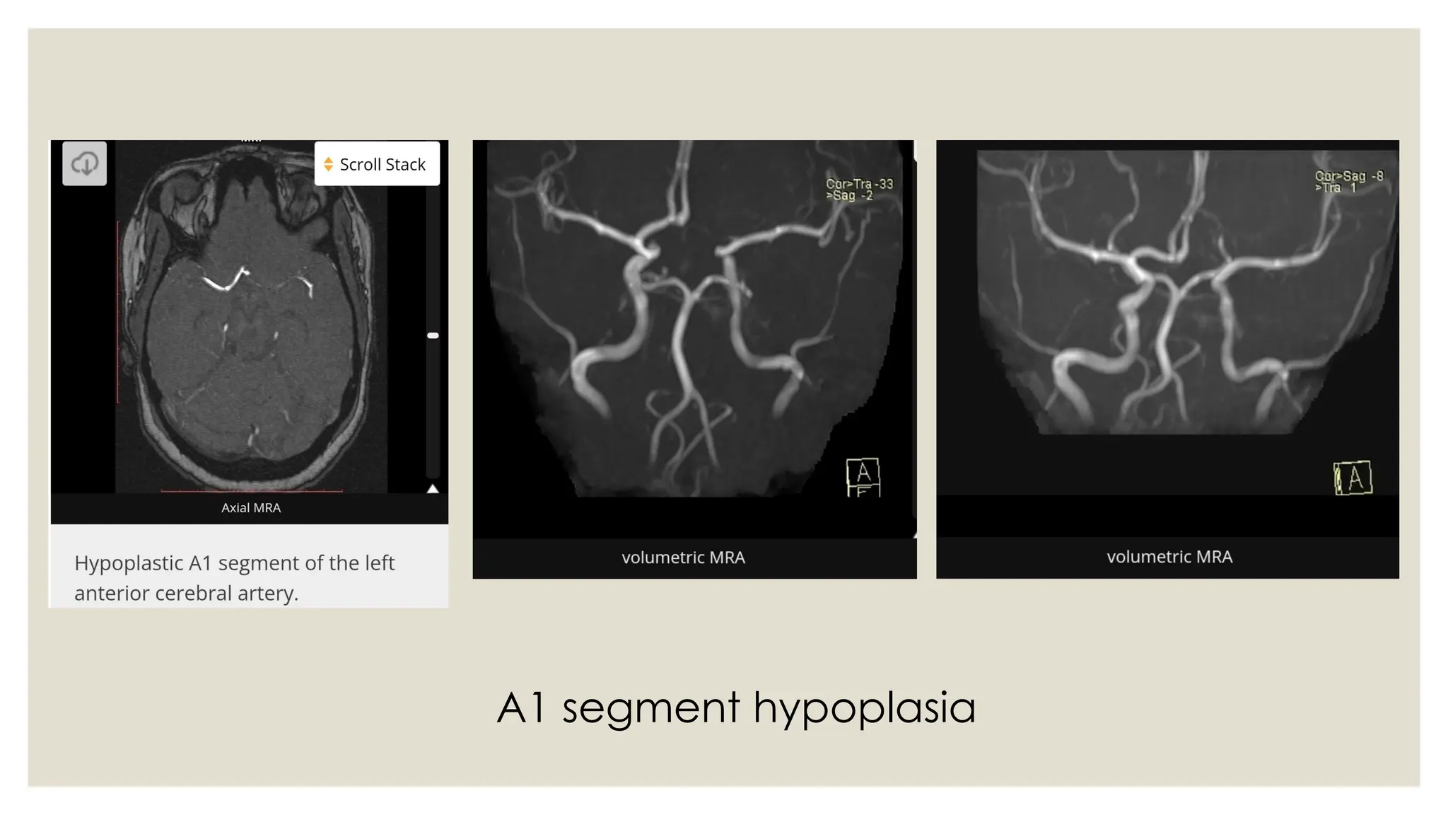 Anterior Cerebral Artery, anatomy, segments, pathologies, radiology | PPTX