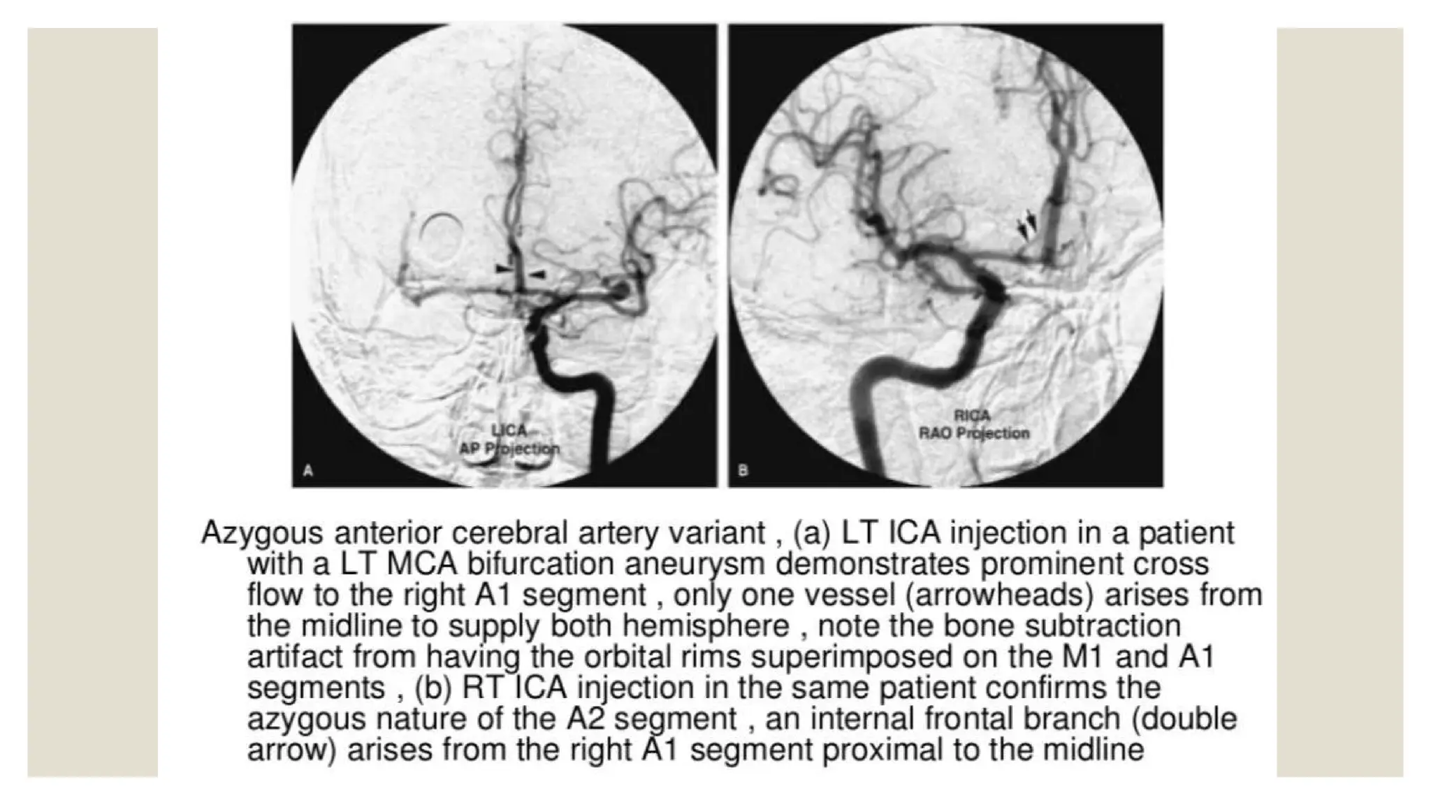 Anterior Cerebral Artery, anatomy, segments, pathologies, radiology | PPTX