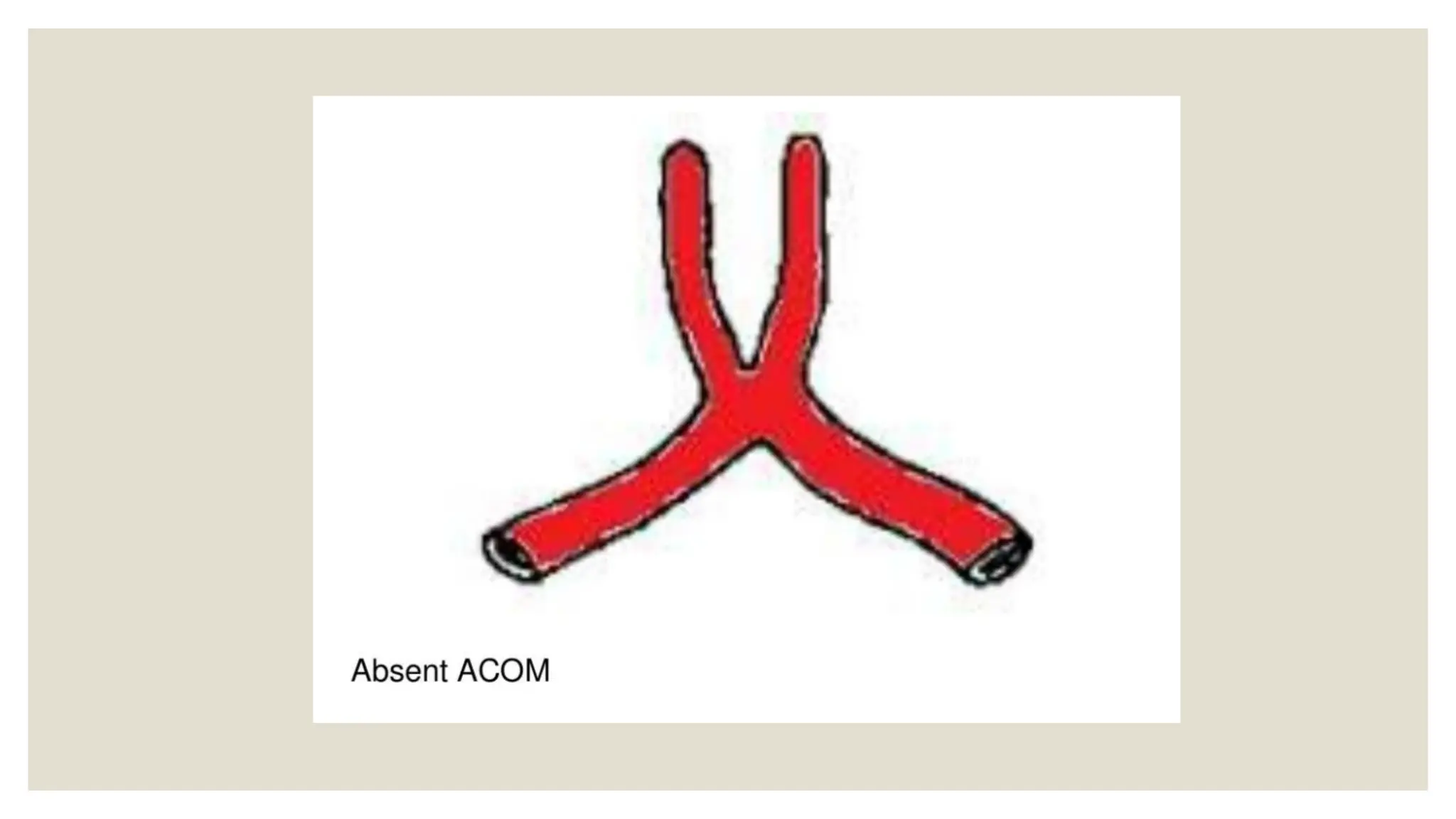 Anterior Cerebral Artery, anatomy, segments, pathologies, radiology | PPTX