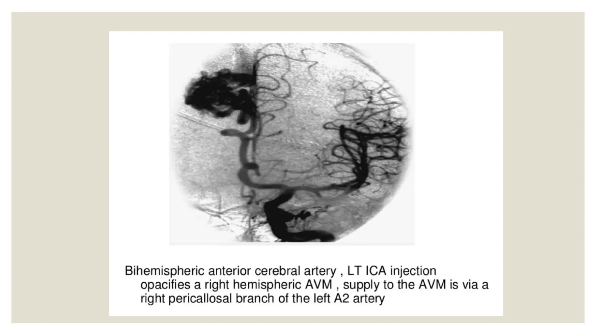 Anterior Cerebral Artery, anatomy, segments, pathologies, radiology | PPTX