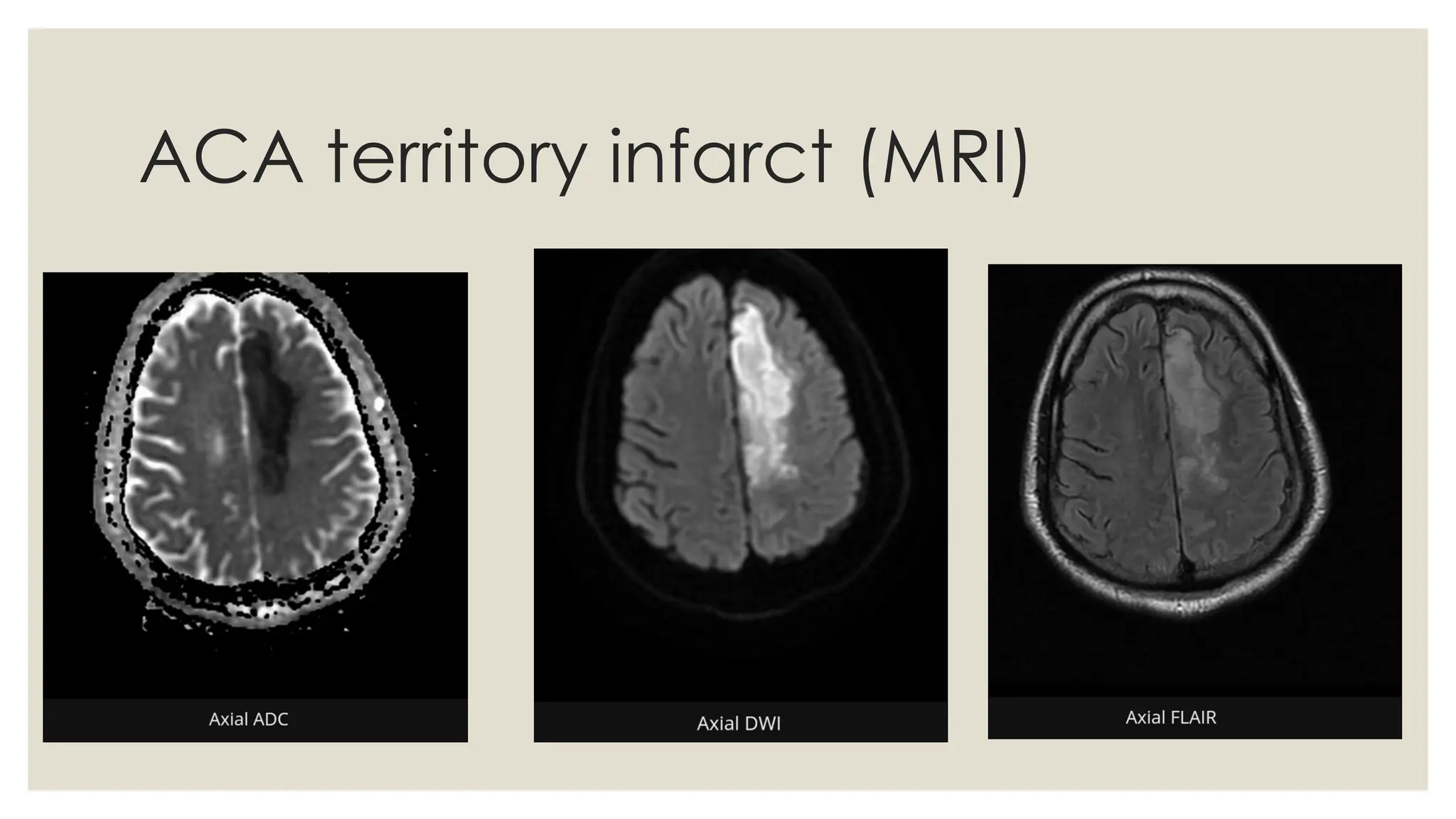 Anterior Cerebral Artery, anatomy, segments, pathologies, radiology | PPTX