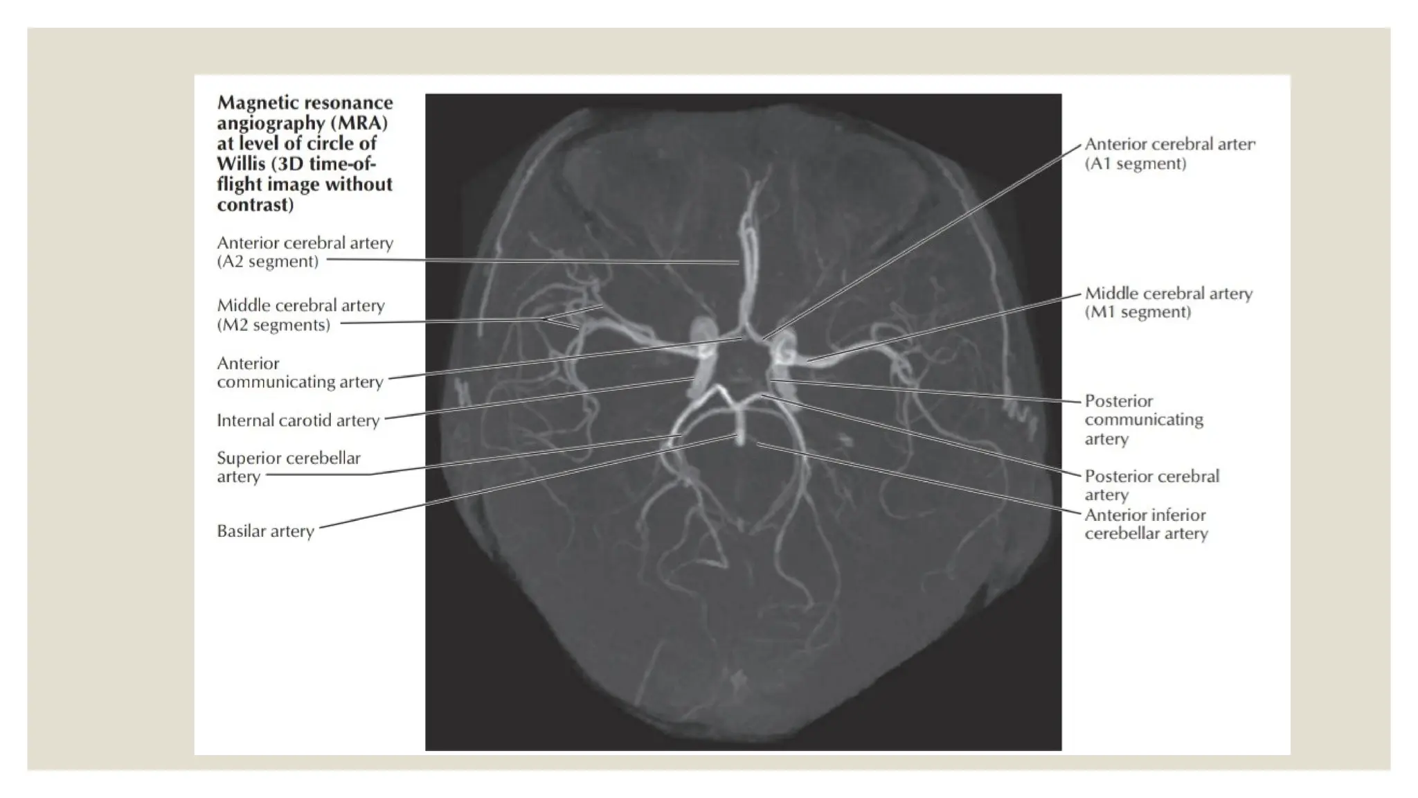 Anterior Cerebral Artery, anatomy, segments, pathologies, radiology | PPTX