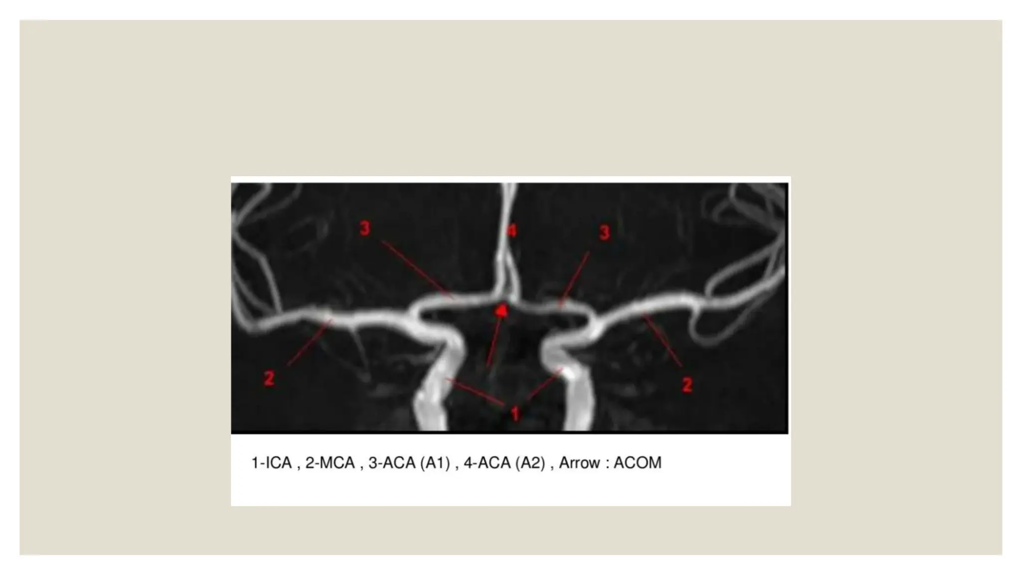 Anterior Cerebral Artery, anatomy, segments, pathologies, radiology | PPTX