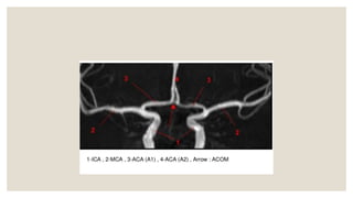 Anterior Cerebral Artery, anatomy, segments, pathologies, radiology | PPTX
