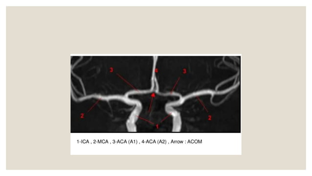 Anterior Cerebral Artery, anatomy, segments, pathologies, radiology | PPT