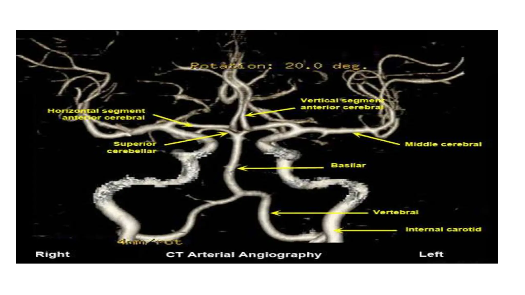 Anterior cerebral circulation aneurysm./ | PPT