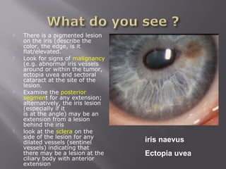 Common cases: Anterior Chamber and Iris | PPT