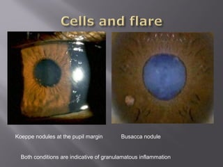 Common cases: Anterior Chamber and Iris | PPT