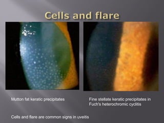 Anterior Chamber Cell