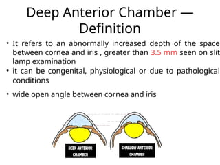 Anterior chamber 3.pptx anterior chamber | PPTX