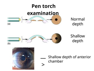Anterior chamber 3.pptx anterior chamber | PPTX