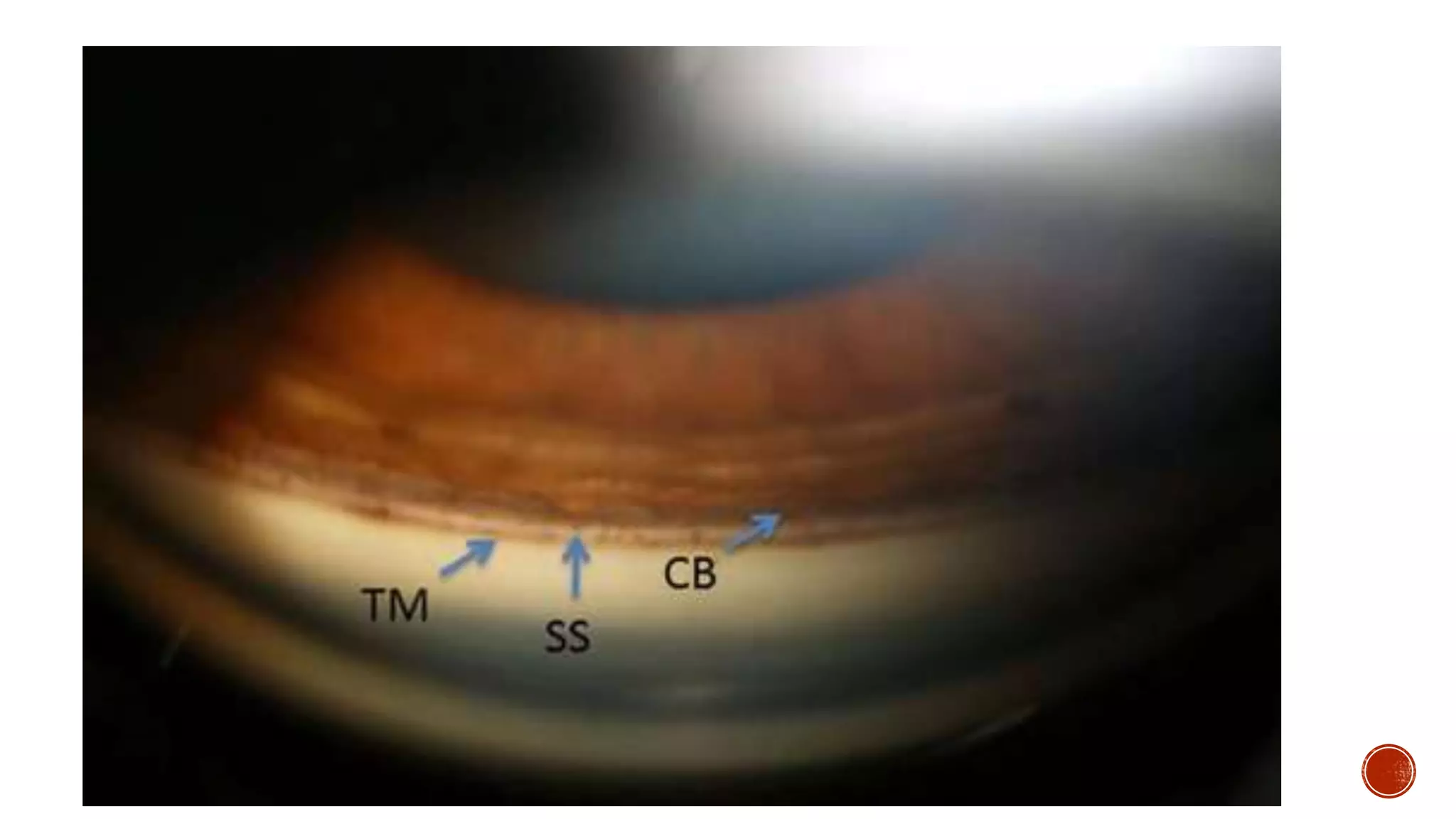 Anterior chamber and aquous humour | PPTX | Eye and Vision Conditions ...